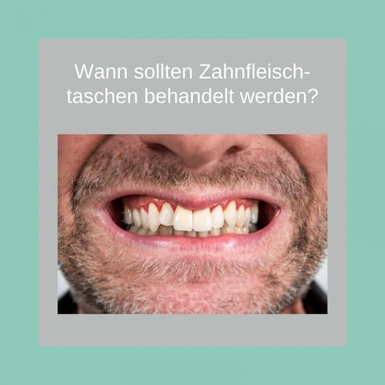 Wann sollten Zahnfleischtaschen behandelt werden? - Dr. Marlene Kreißel